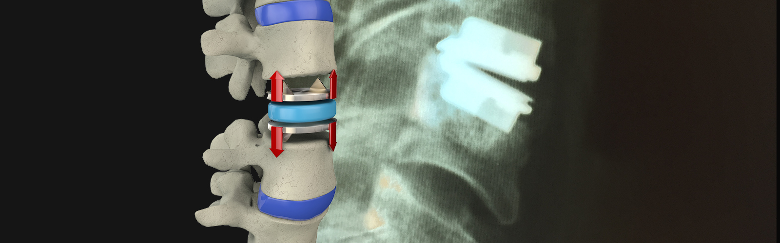 DISC REPLACEMENT | Atlantic Spine Specialists | Morristown NJ